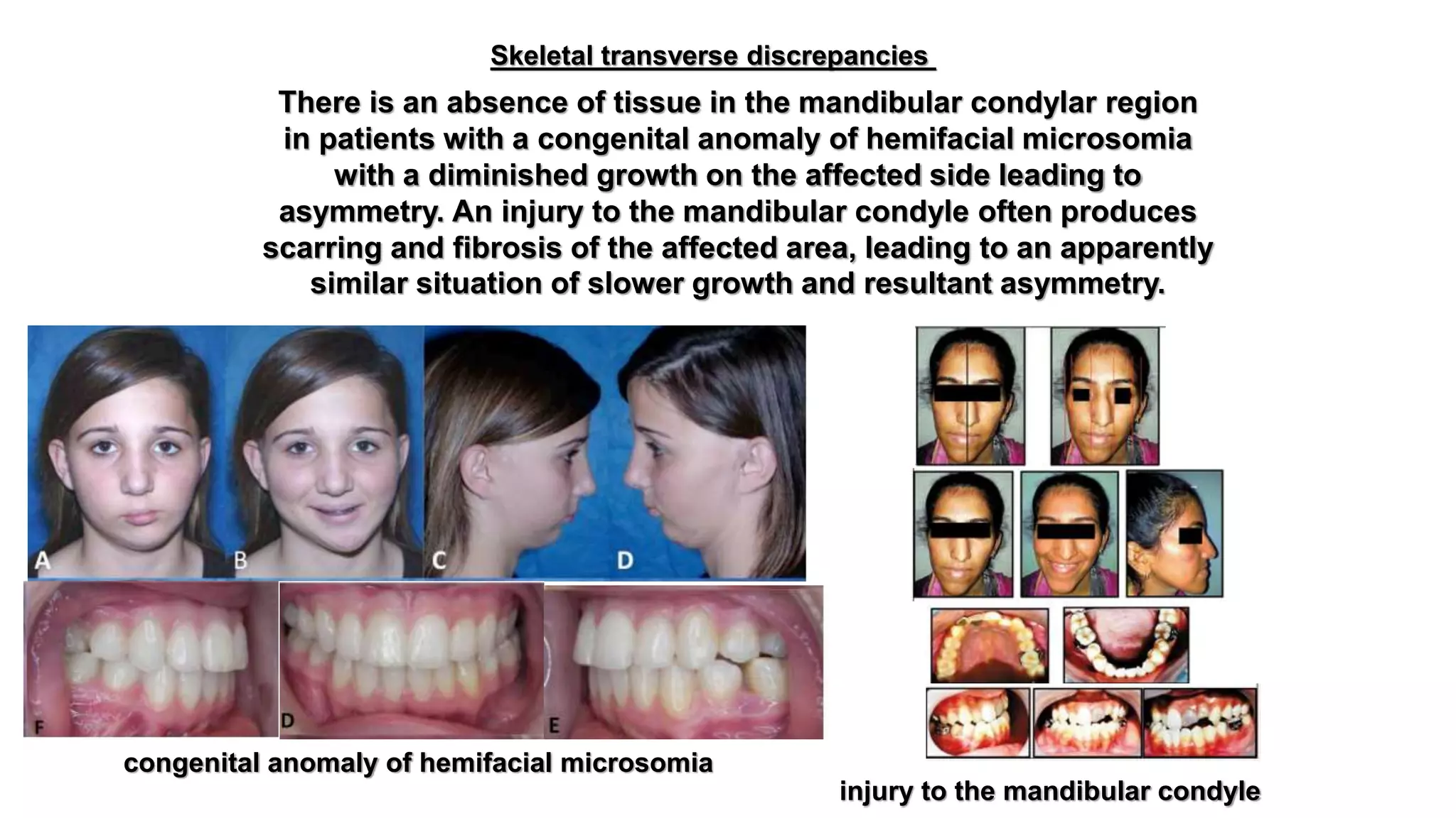 Transverse discrepancies | PPTX
