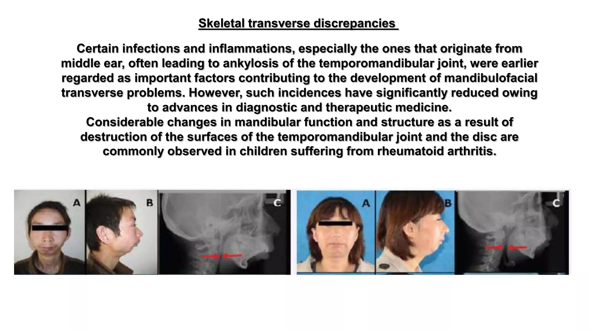 Transverse discrepancies | PPTX