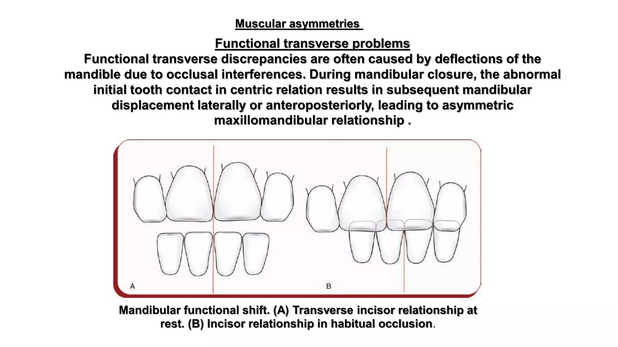 Transverse discrepancies | PPTX