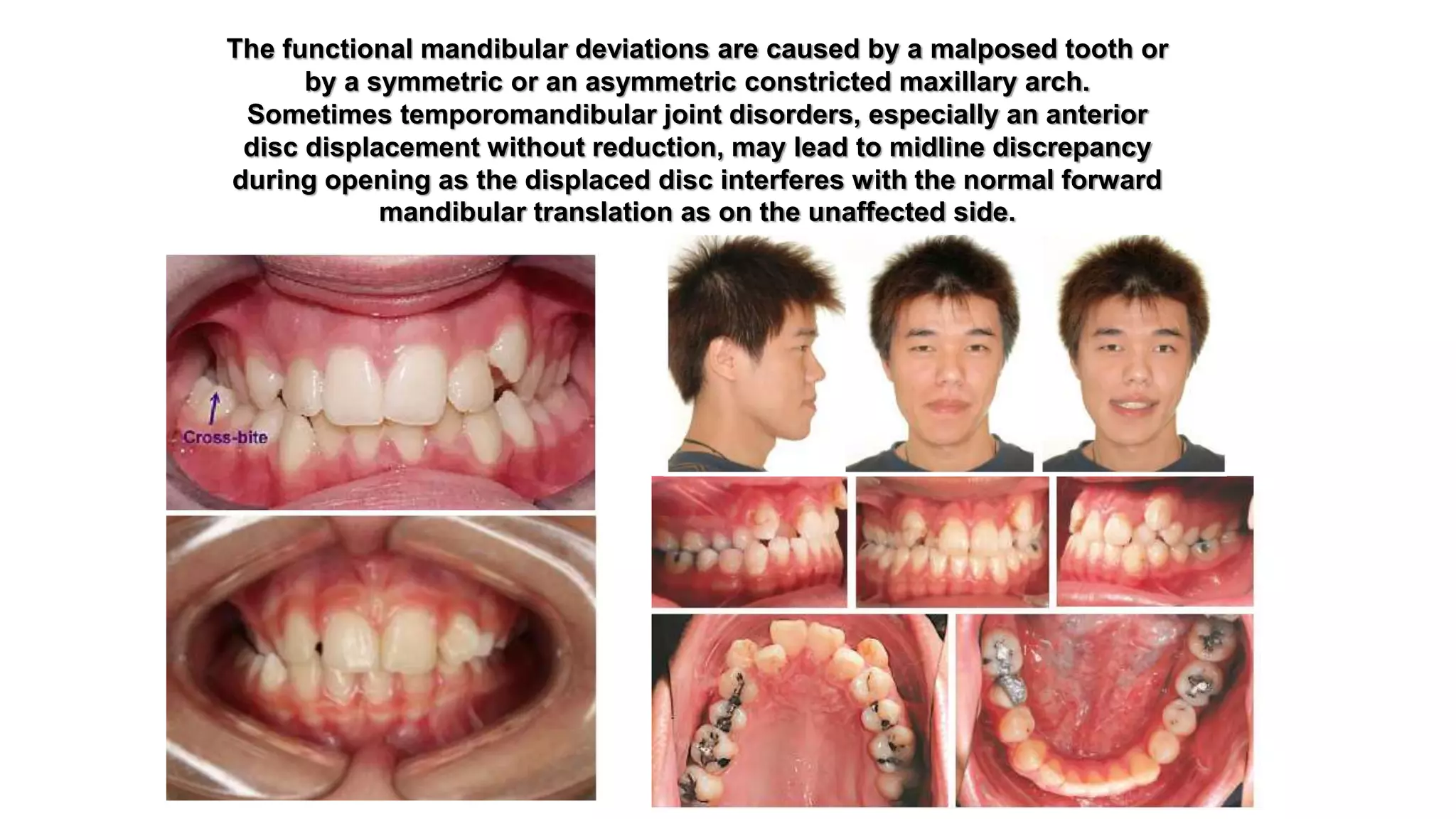Transverse discrepancies | PPTX