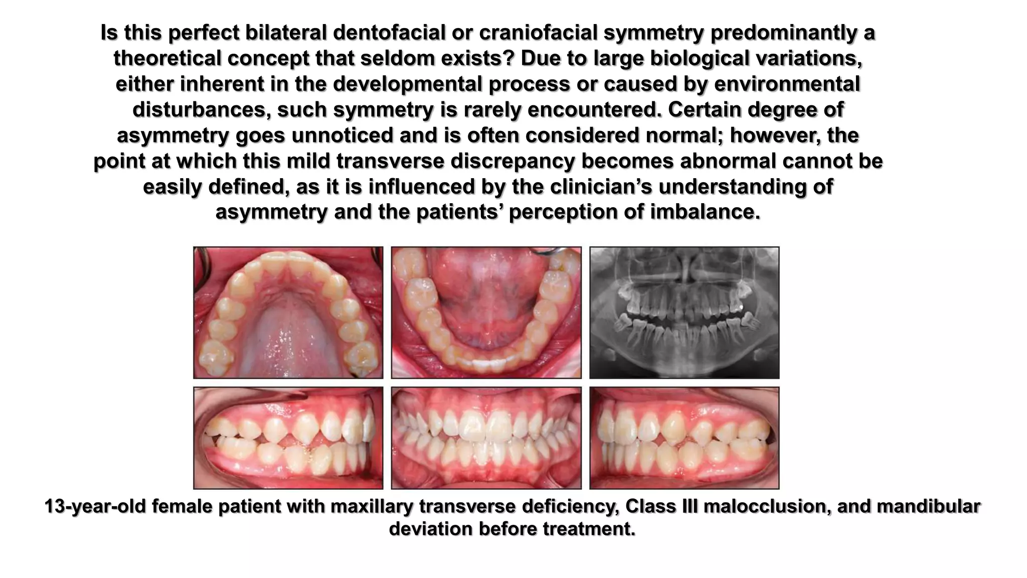 Transverse discrepancies | PPTX