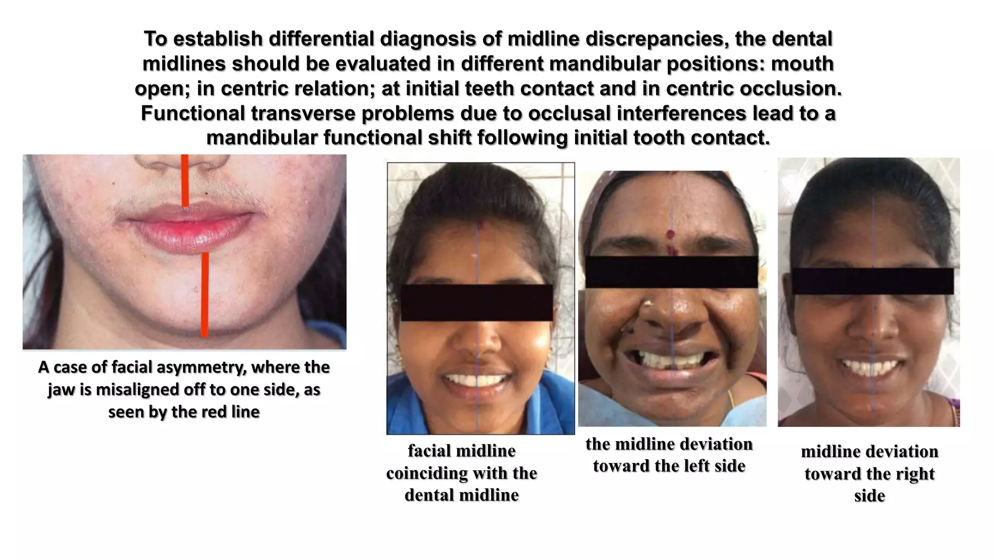 Transverse discrepancies | PPTX