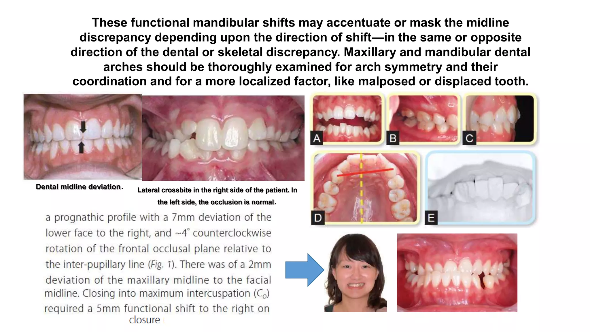 Transverse discrepancies | PPTX
