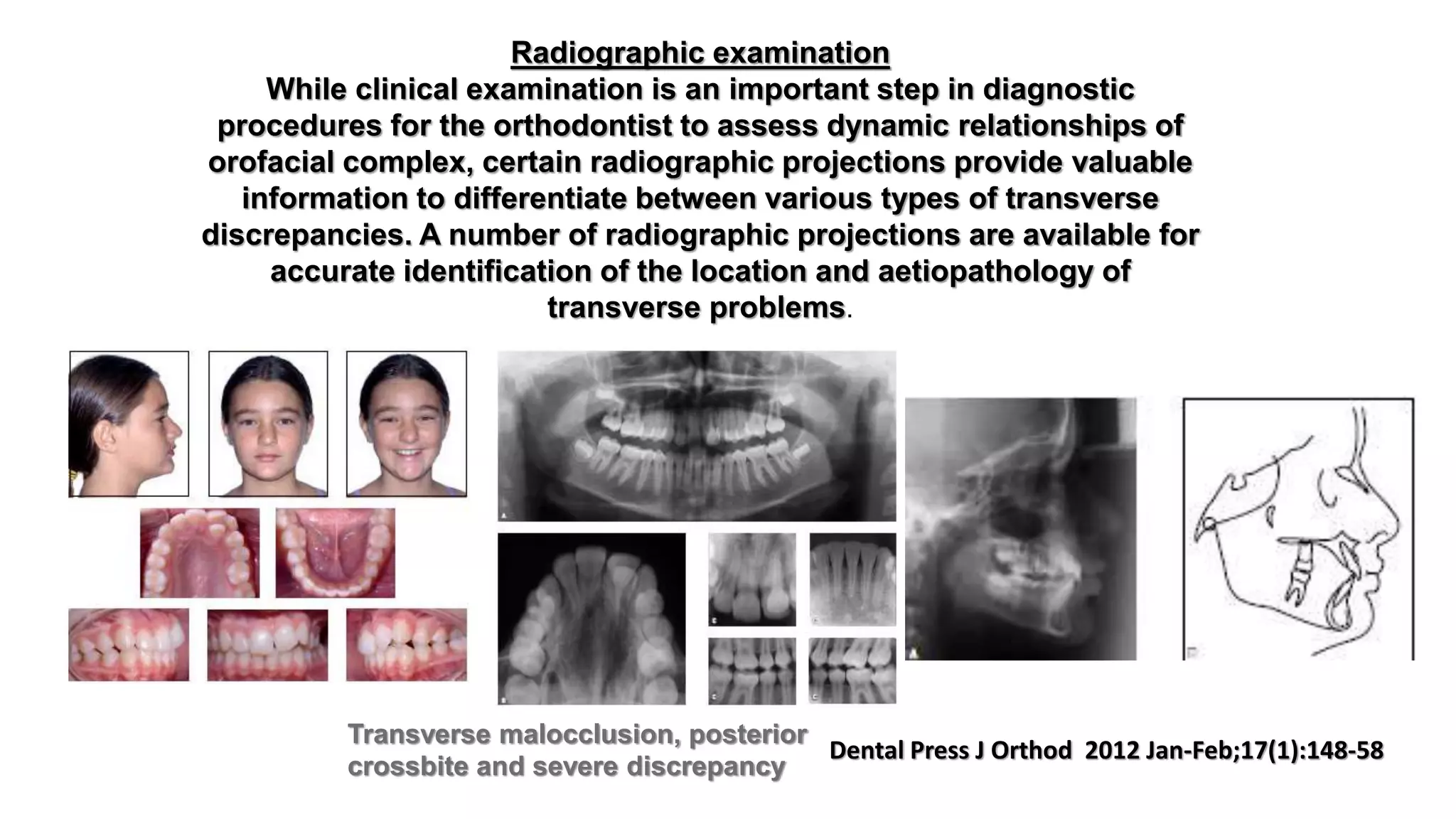 Transverse discrepancies | PPTX