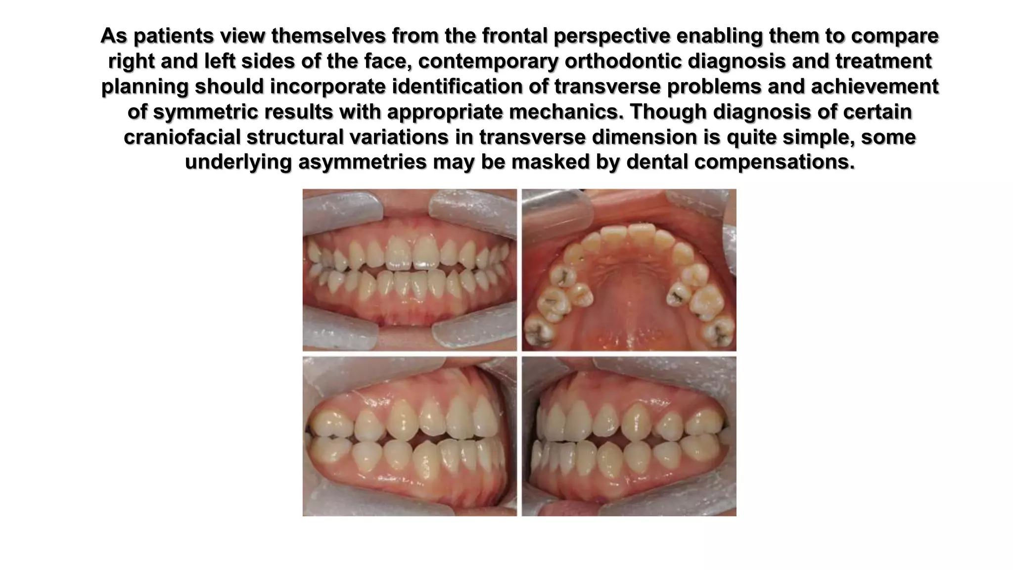 Transverse discrepancies | PPTX
