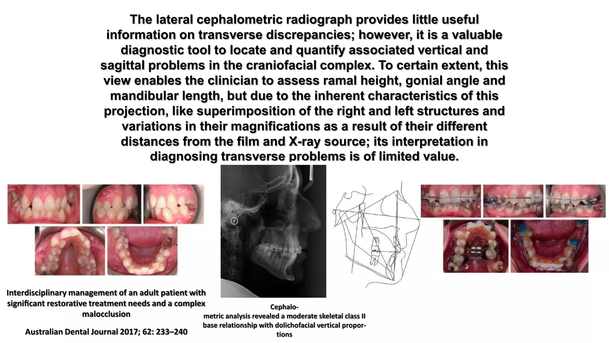 Transverse discrepancies | PPTX