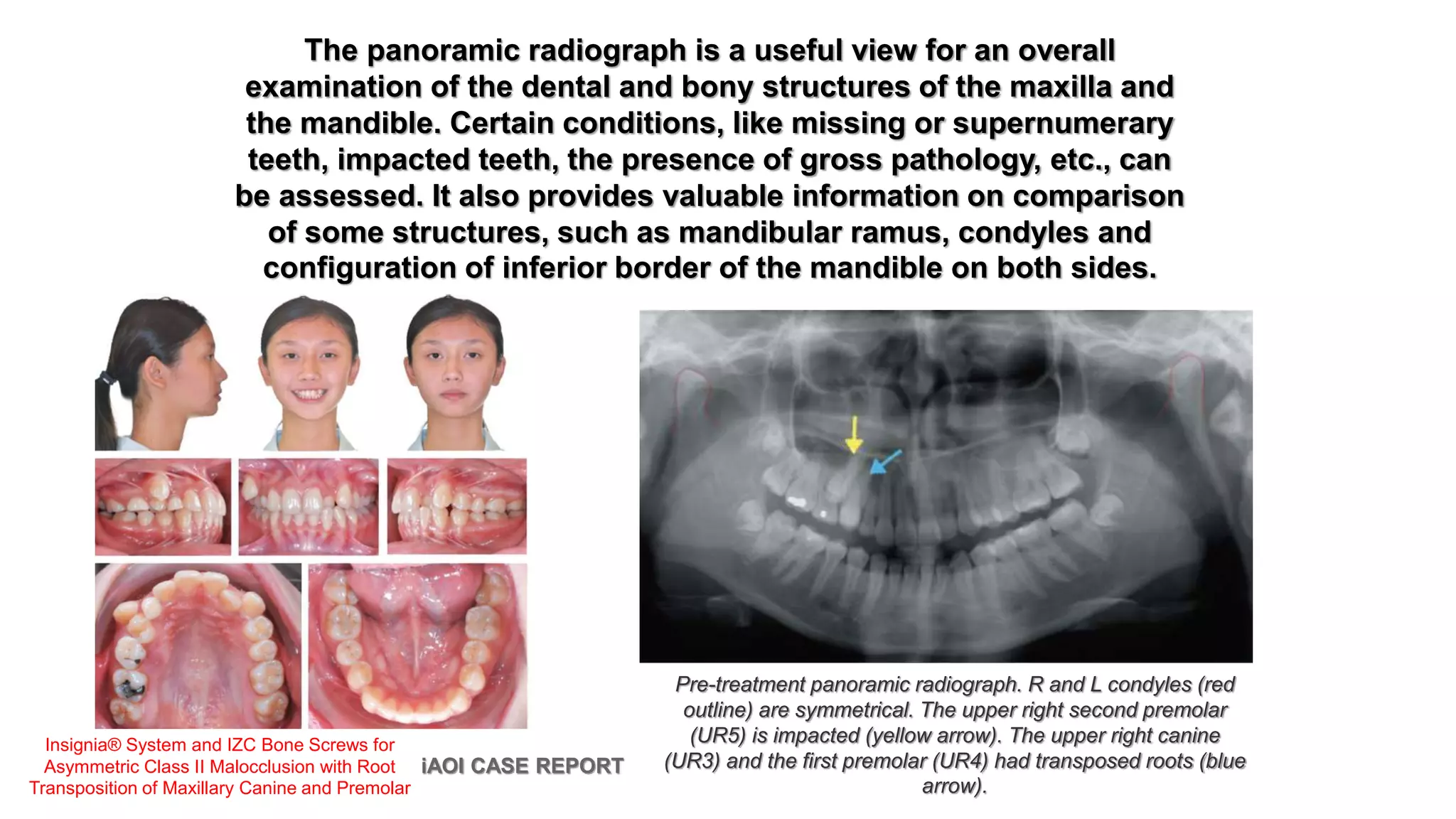 Transverse discrepancies | PPTX