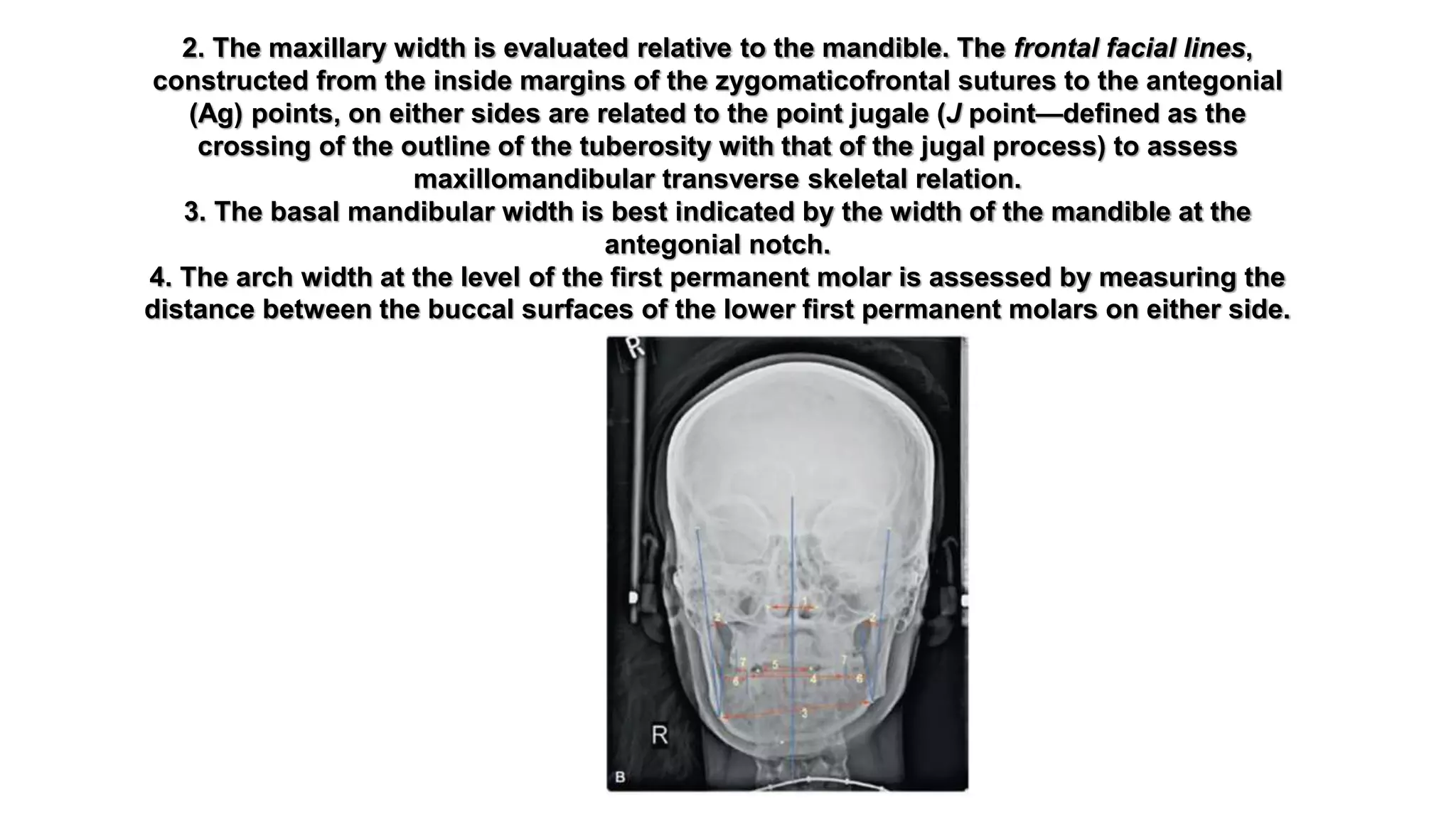 Transverse discrepancies | PPTX