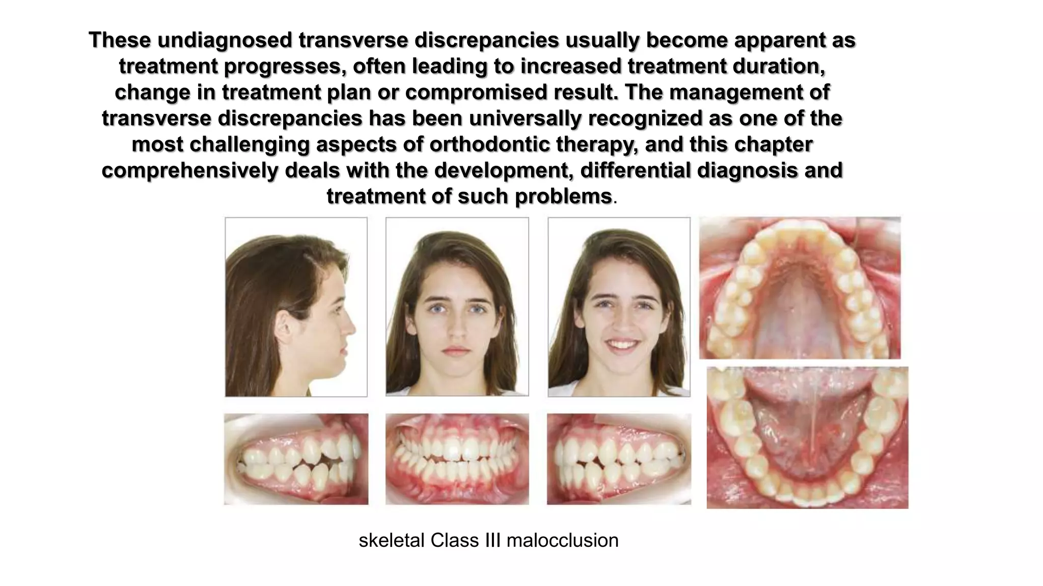 Transverse discrepancies | PPTX