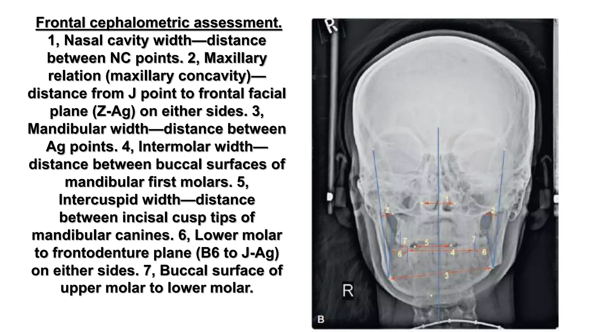 Transverse discrepancies | PPTX