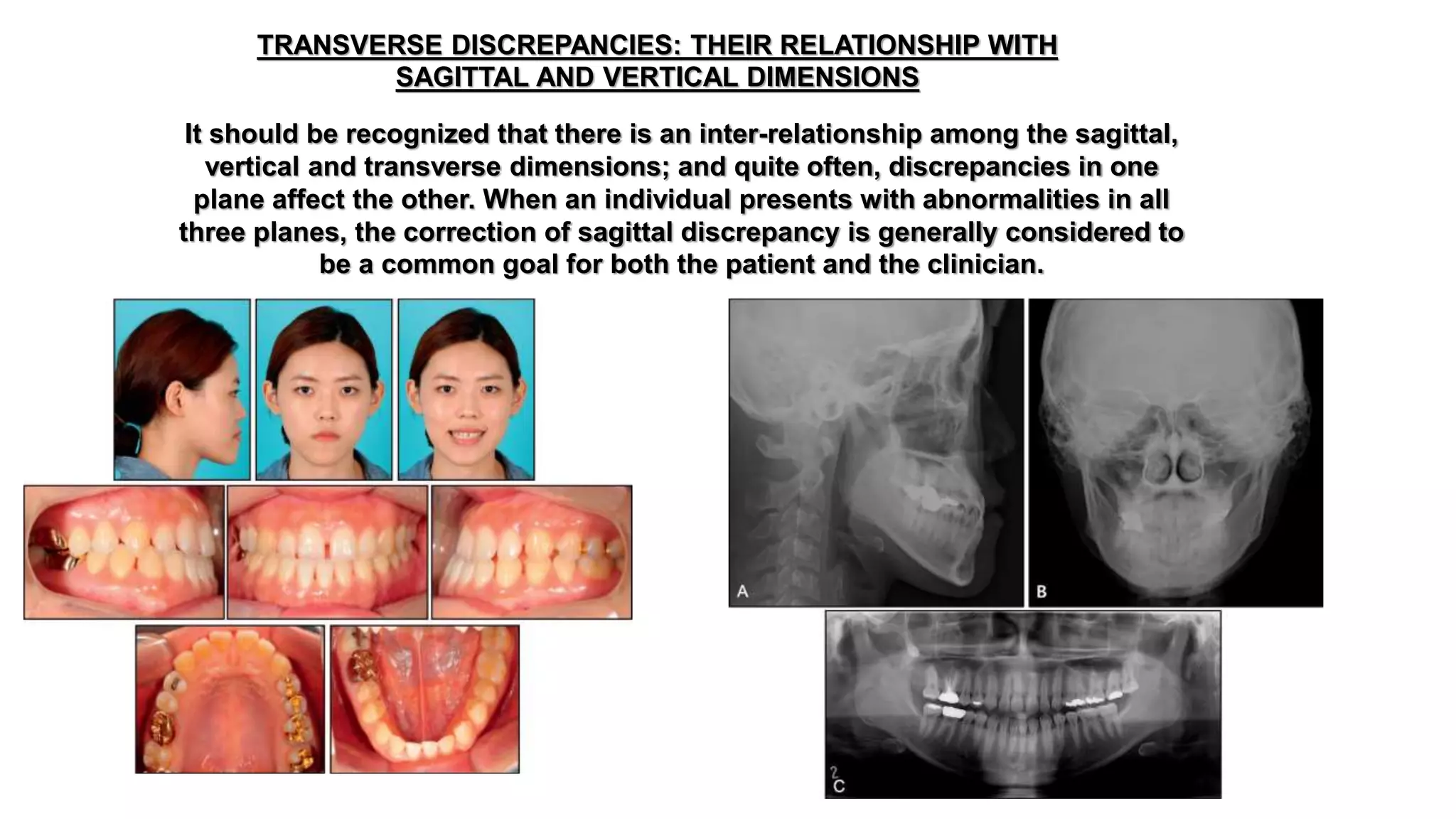 Transverse discrepancies | PPTX