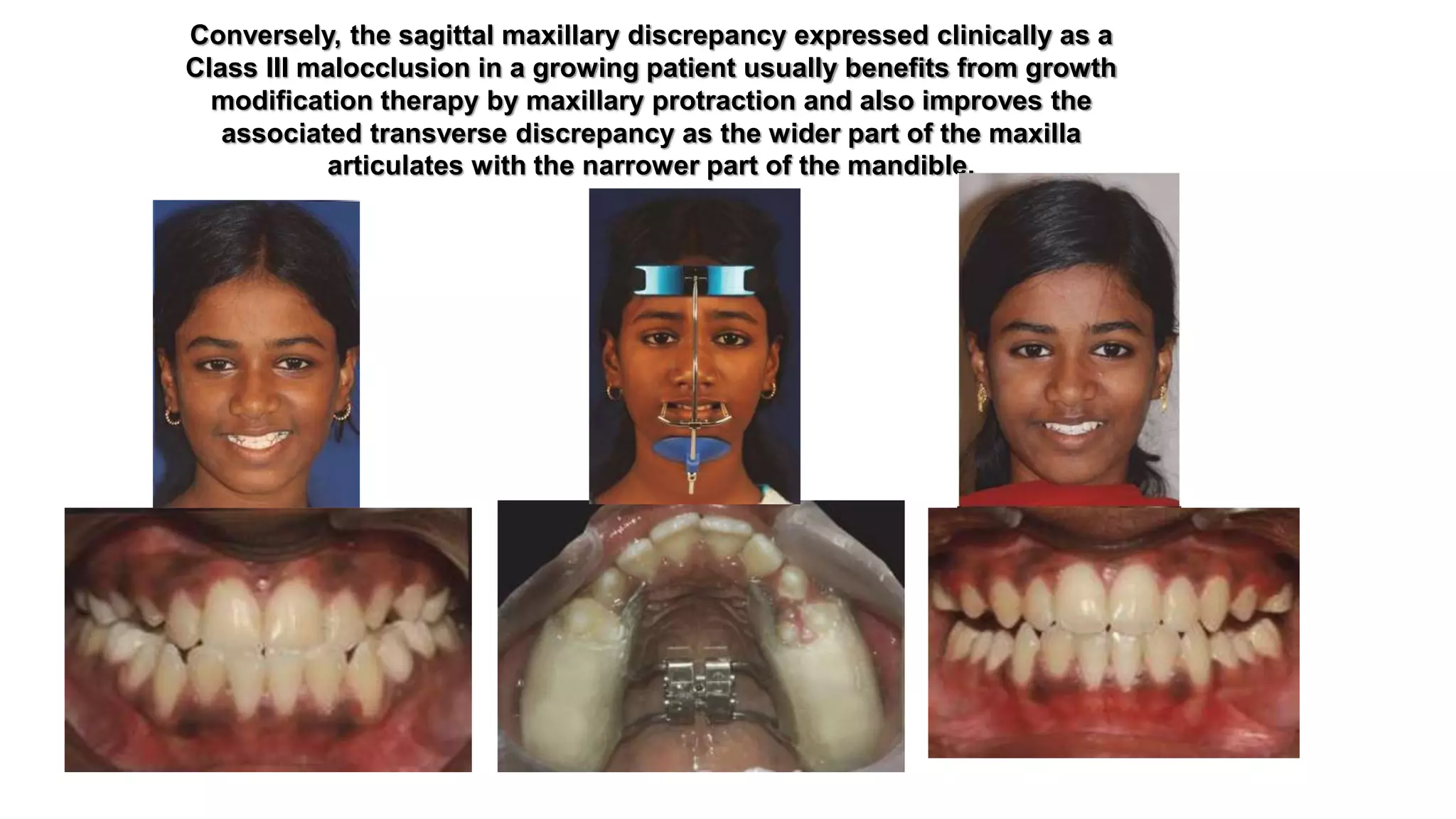 Transverse discrepancies | PPTX