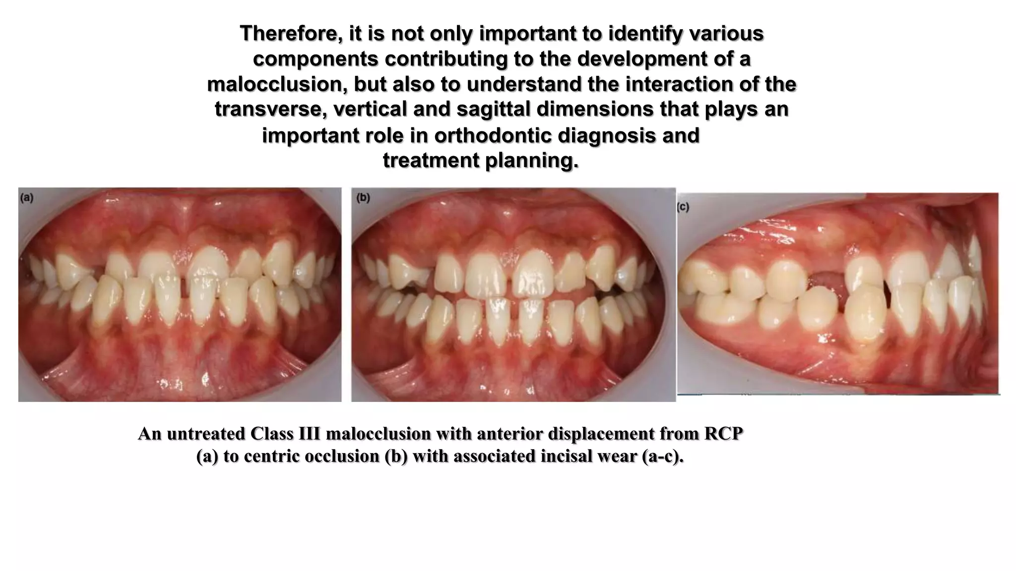 Transverse discrepancies | PPTX