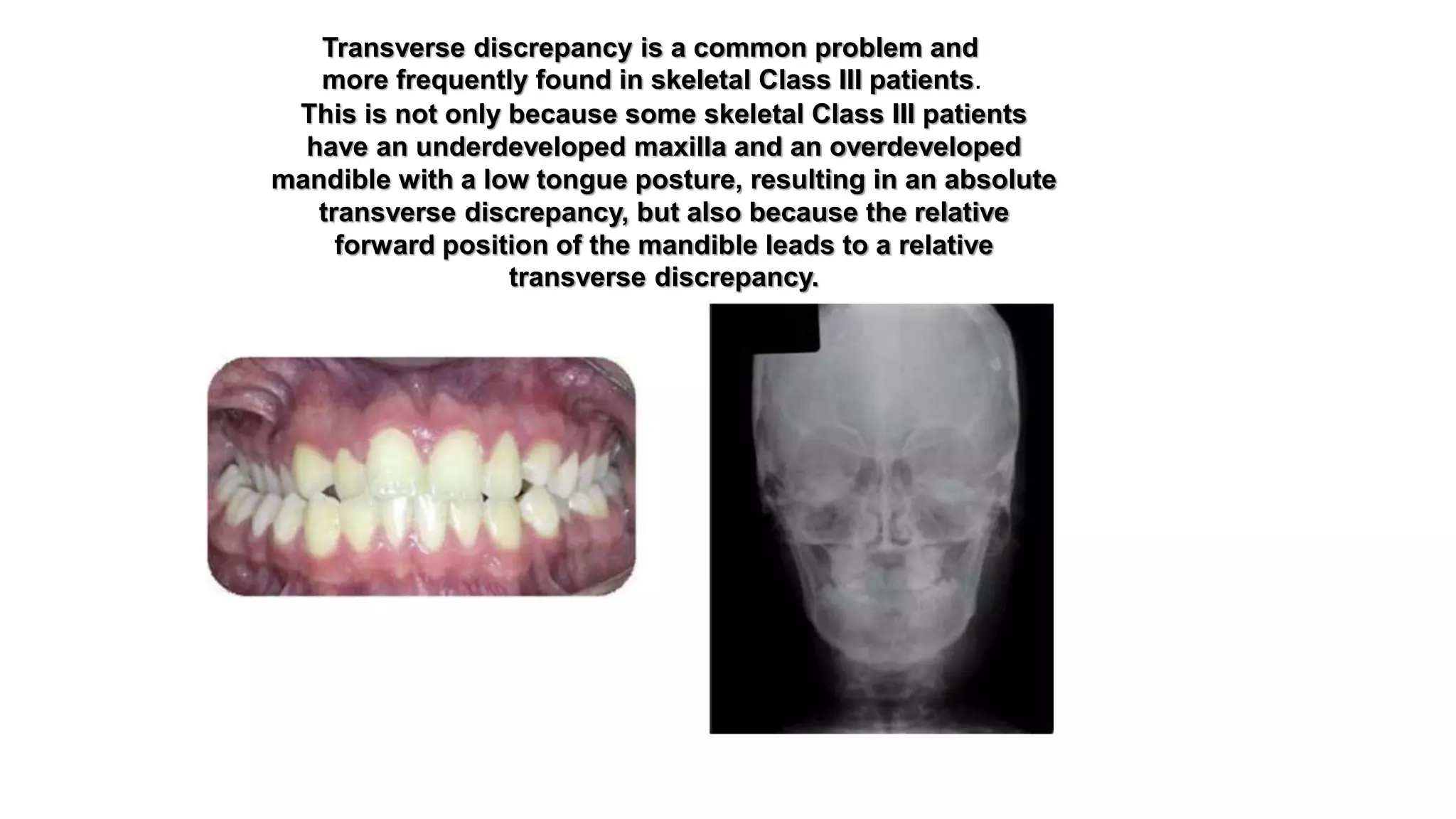 Transverse discrepancies | PPTX
