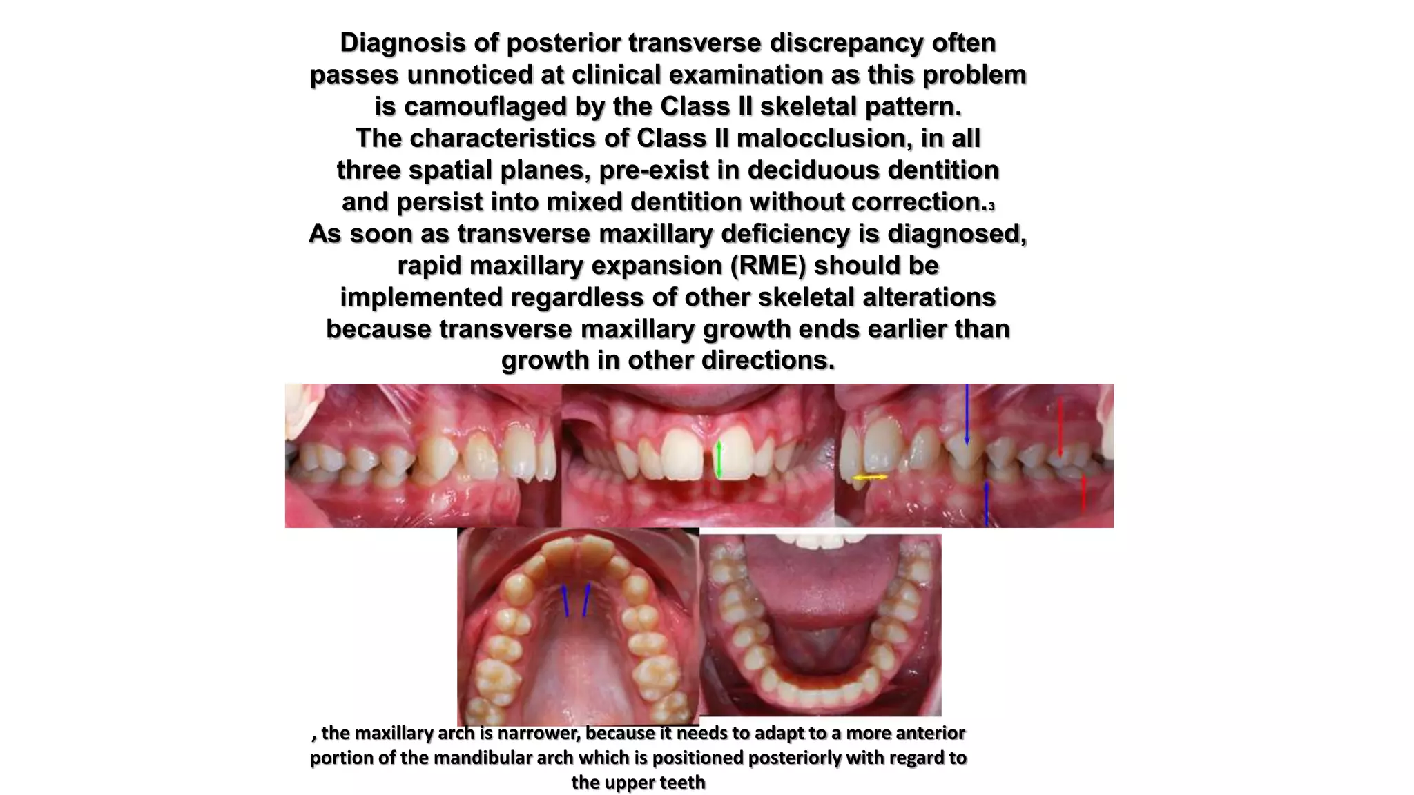 Transverse discrepancies | PPTX