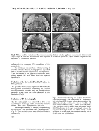 Transverse effects of surgically assisted rapid maxillary expansion. | PDF