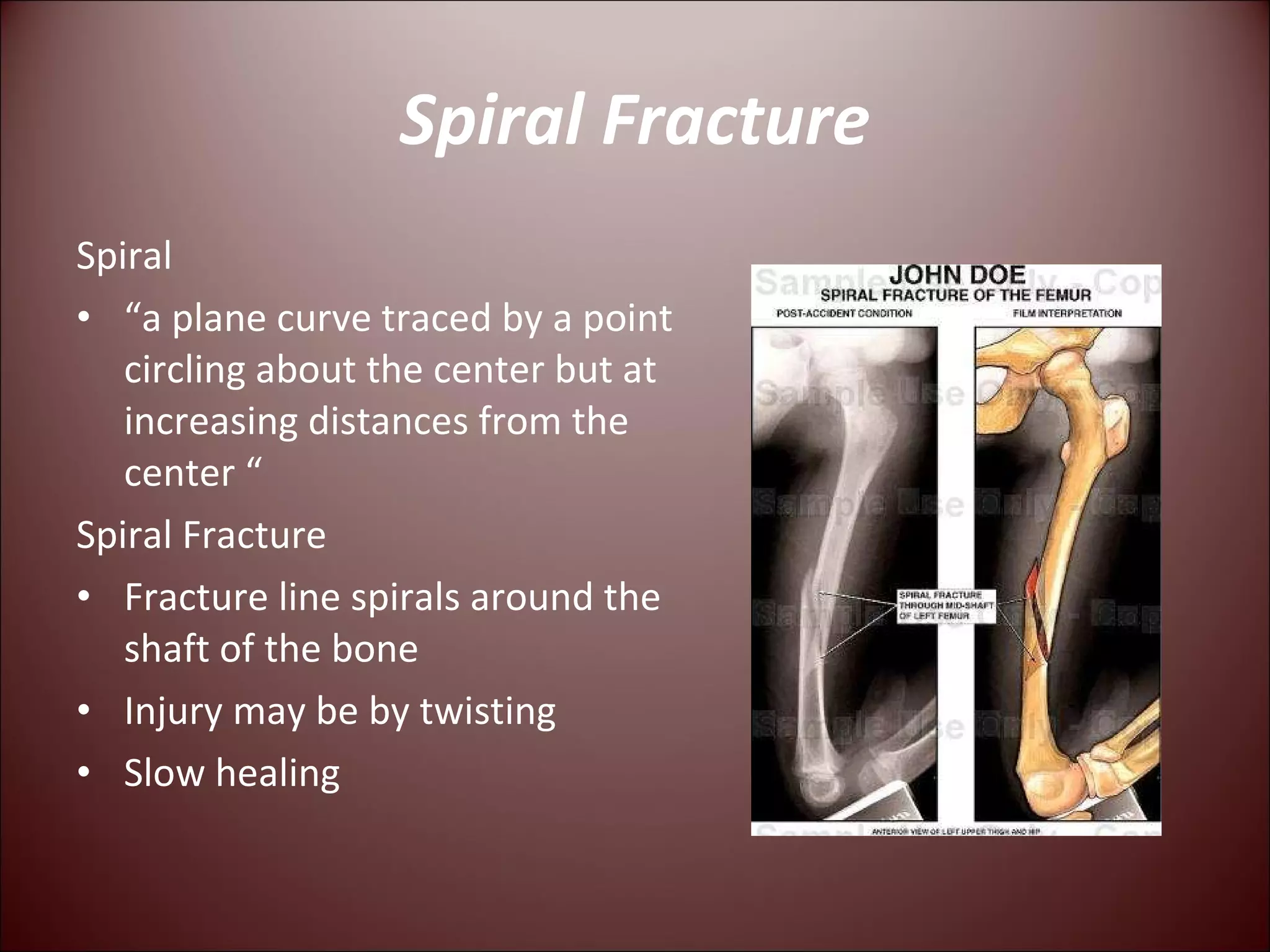 Transverse fracture presentation bio 120 | PPT