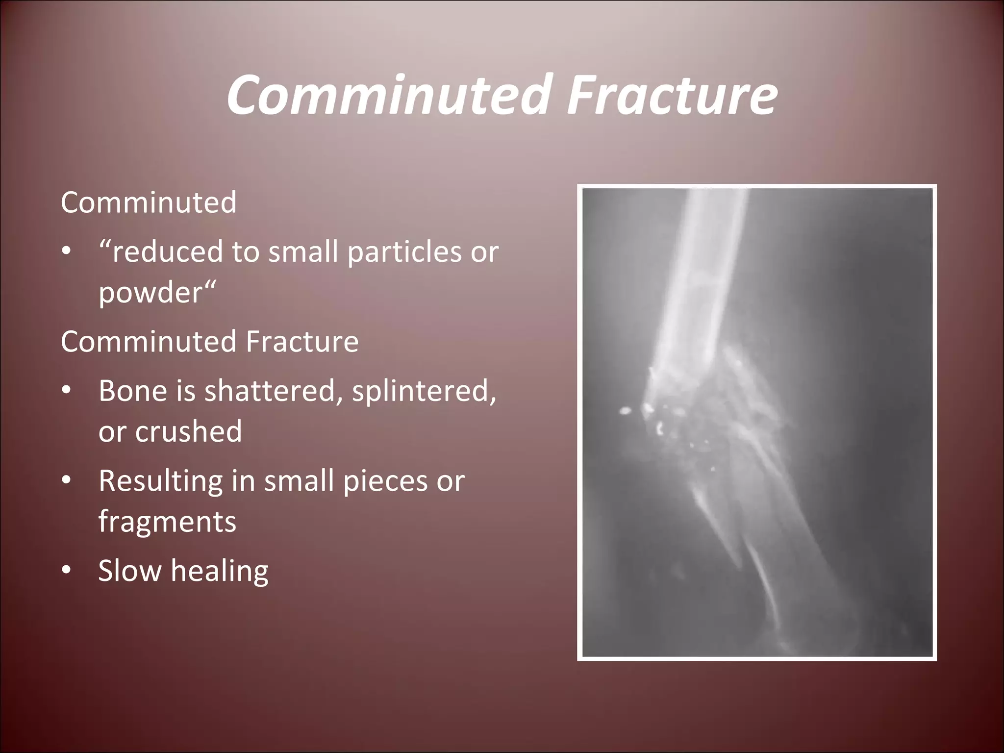 Transverse fracture presentation bio 120 | PPT