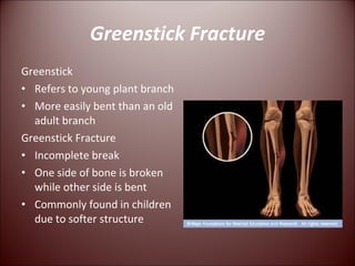 Transverse fracture presentation bio 120 | PPT