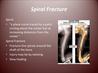 Transverse fracture presentation bio 120 | PPT