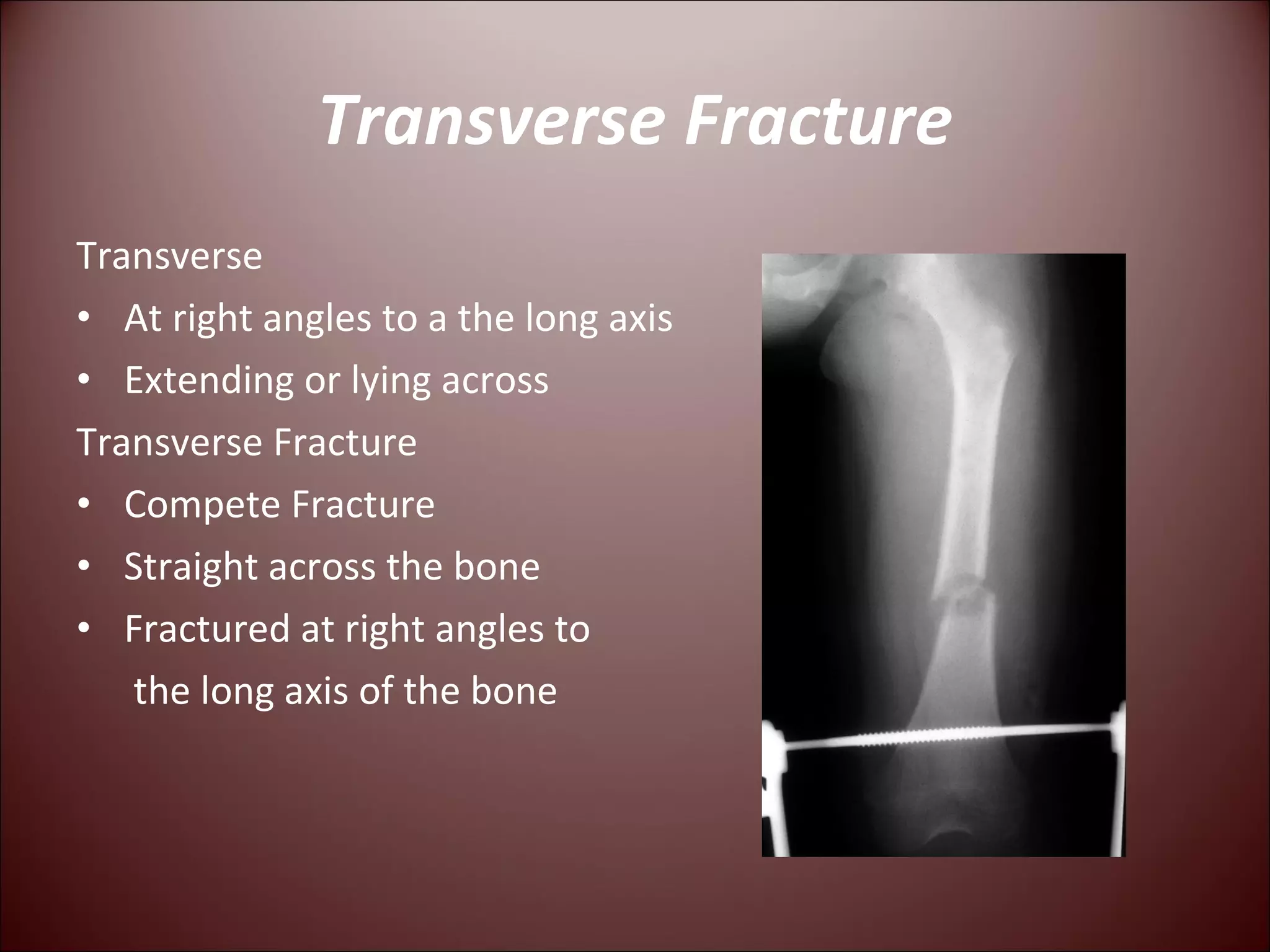 Transverse Fracture Presentation Bio 120 Ppt