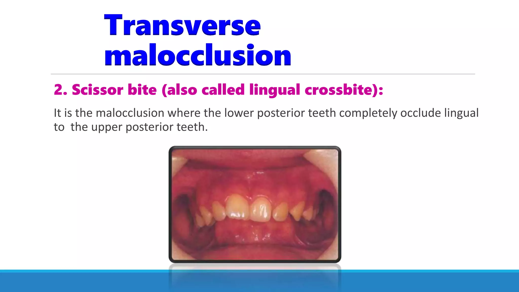 Transverse malocclusion (crossbite) | PPTX