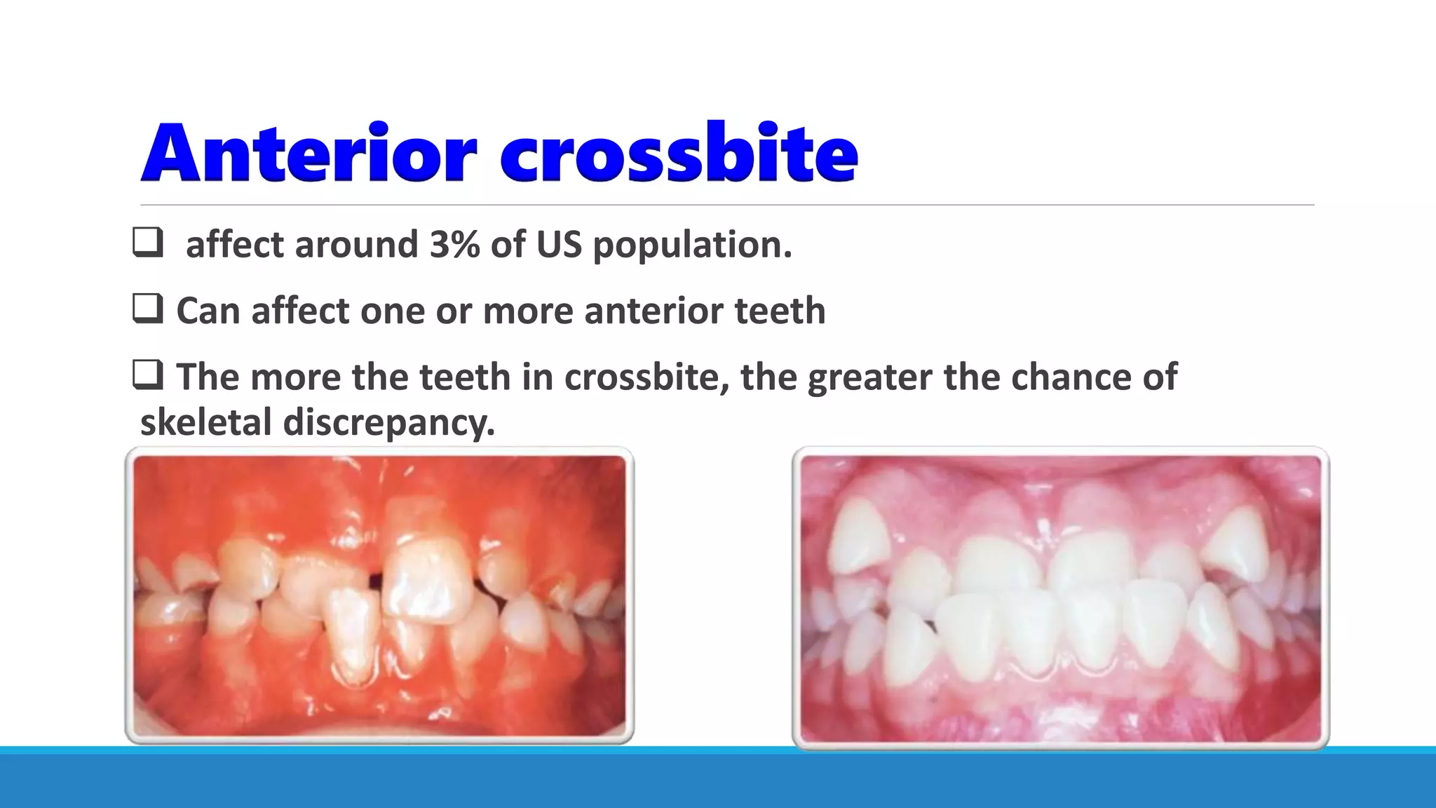 Transverse malocclusion (crossbite) | PPTX