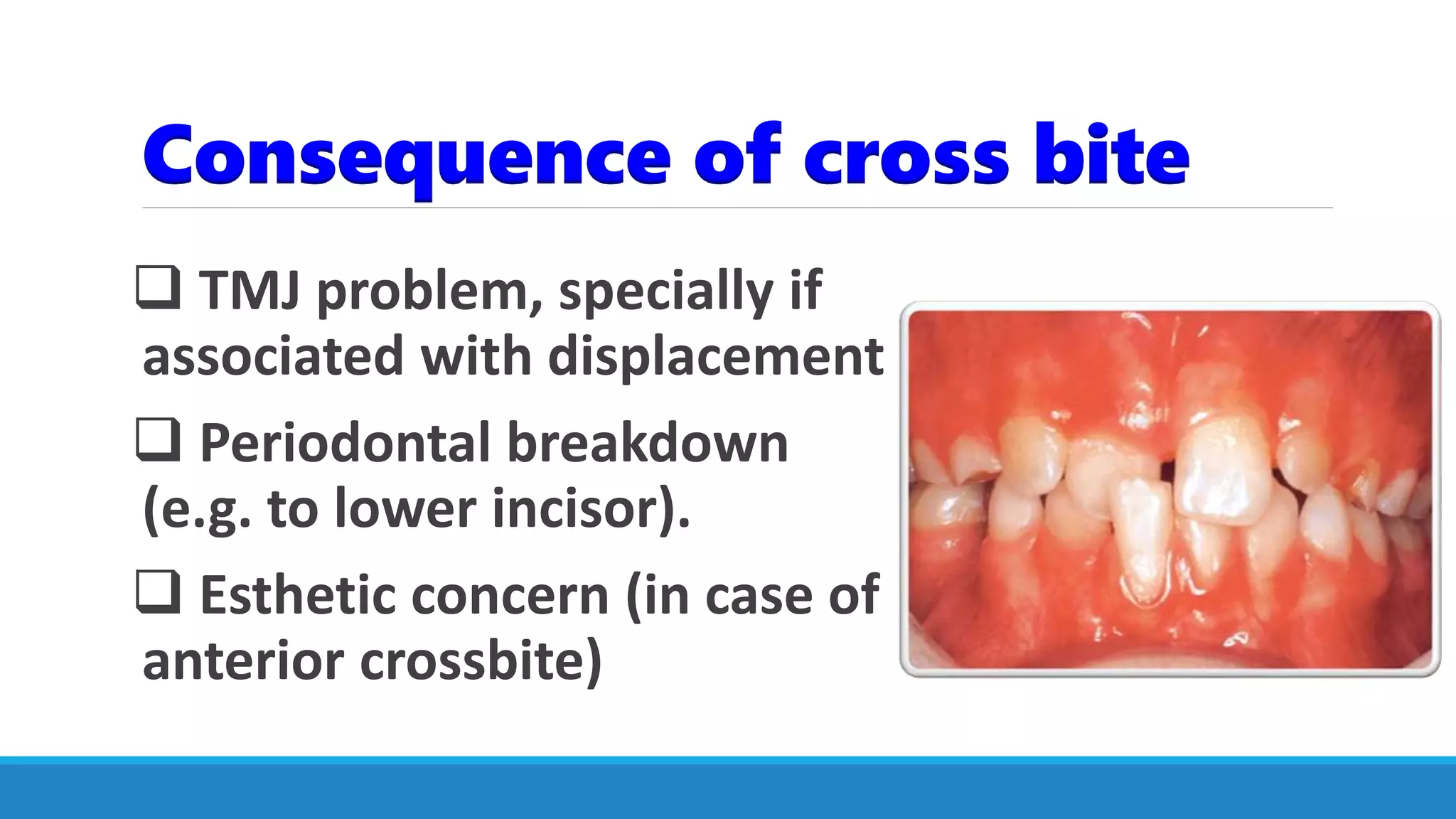 Transverse malocclusion (crossbite) | PPTX