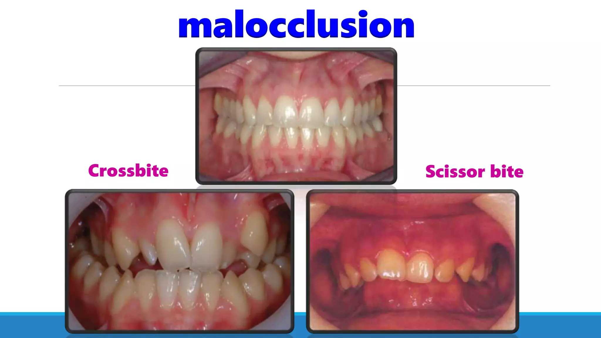 Transverse malocclusion (crossbite) | PPTX