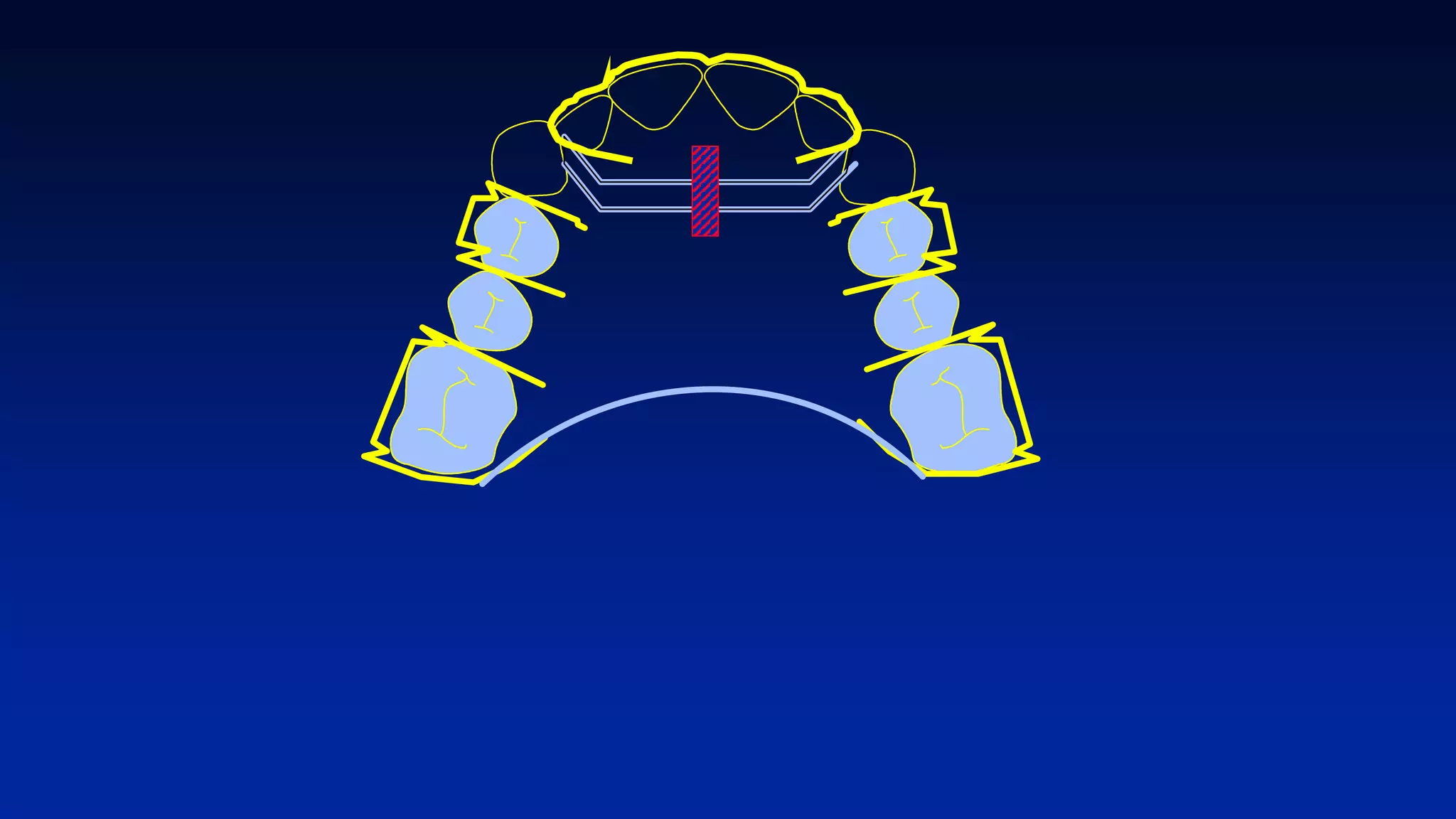 Transverse malocclusion (crossbite) | PPTX