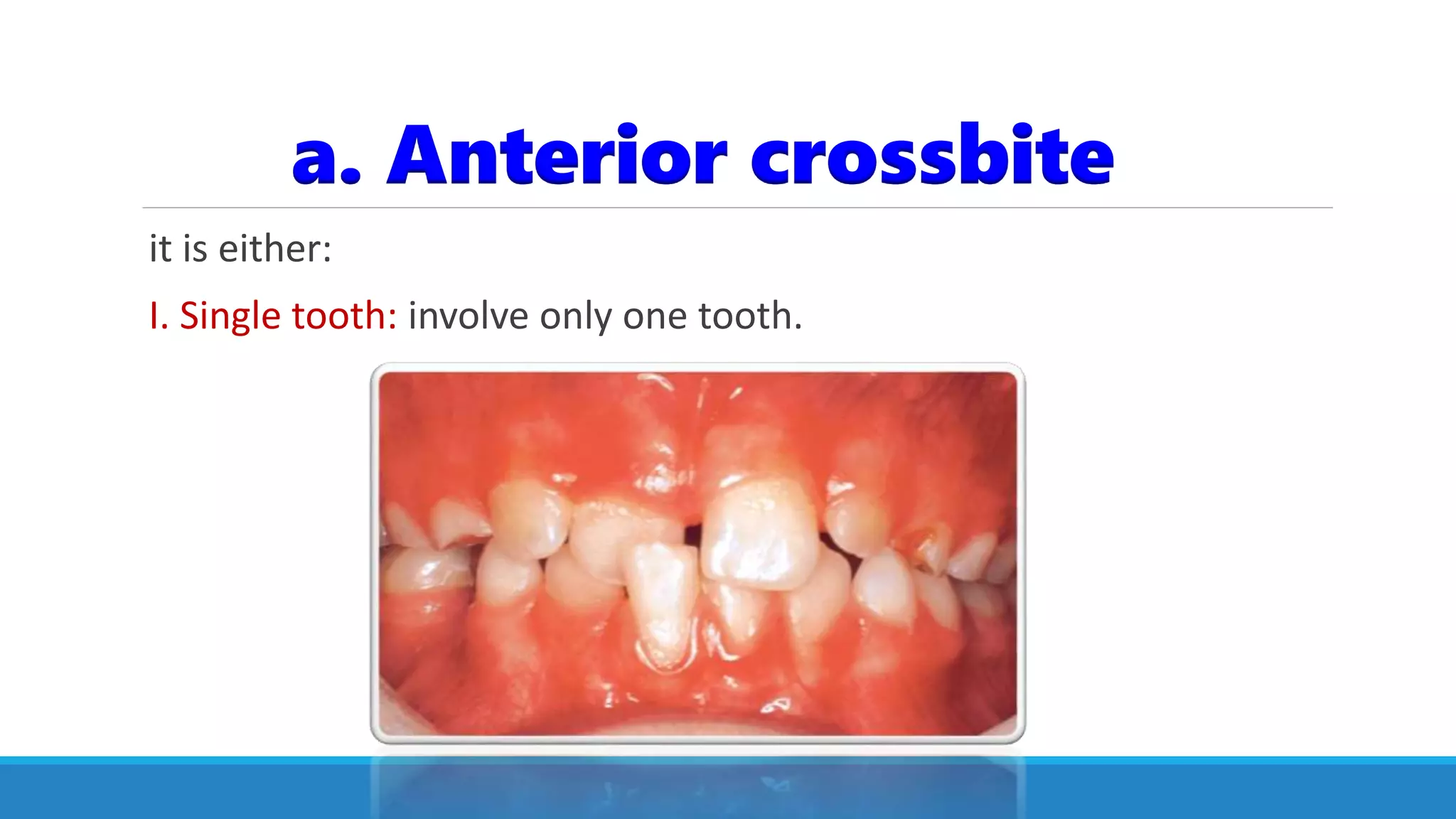 Transverse malocclusion (crossbite) | PPTX