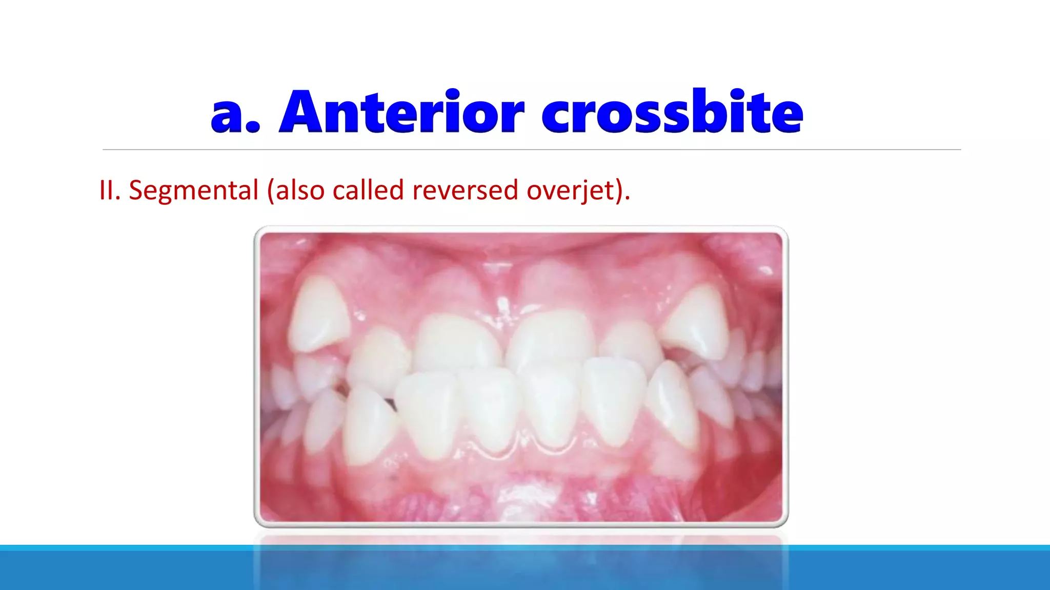 Transverse malocclusion (crossbite) | PPTX