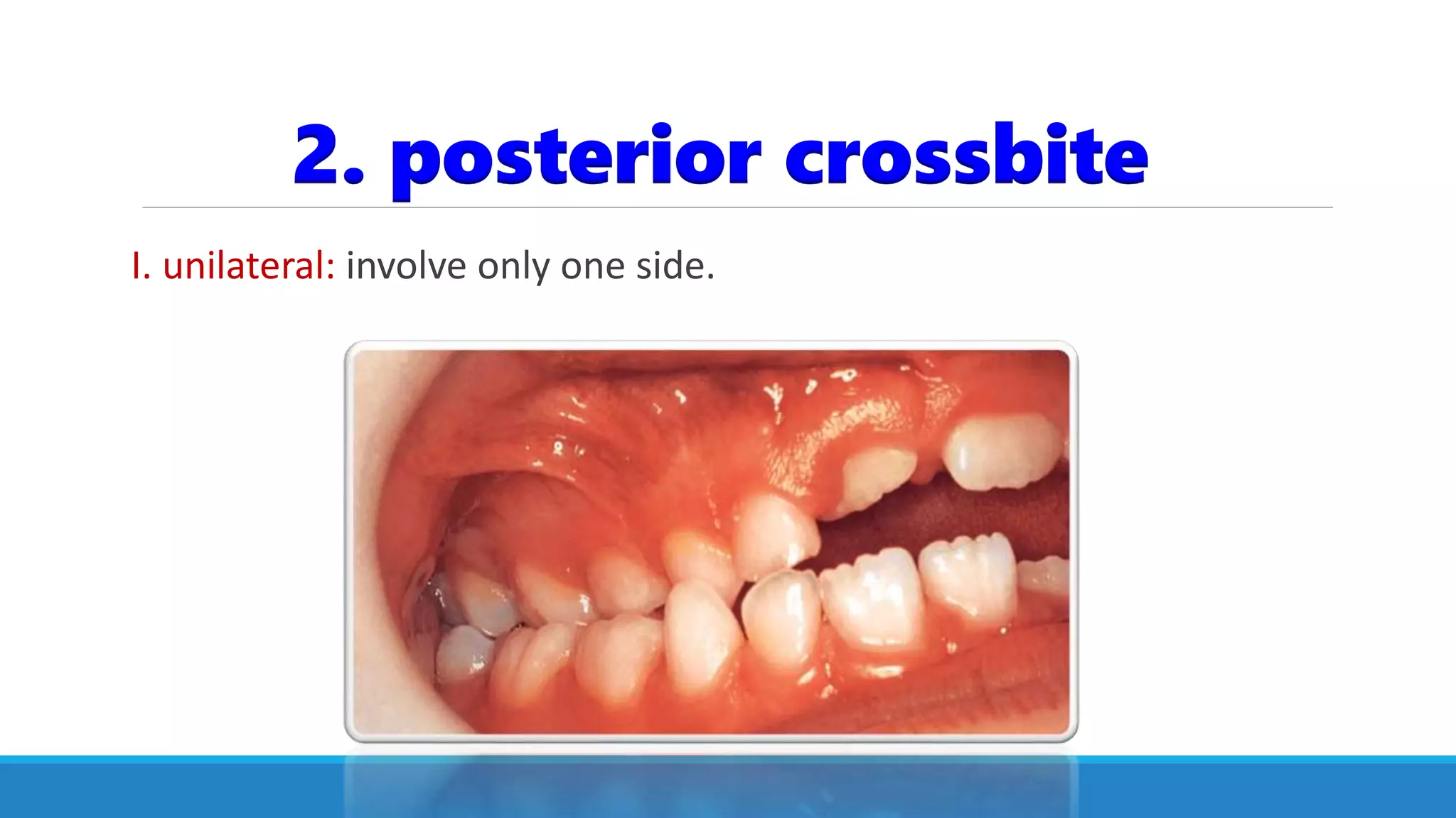 Transverse malocclusion (crossbite) | PPTX