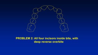 Transverse malocclusion (crossbite) | PPTX
