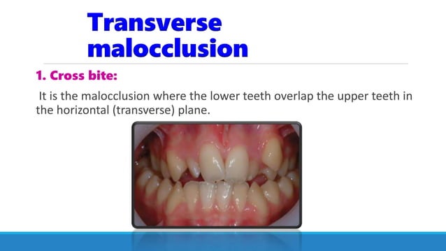 Transverse malocclusion (crossbite) | PPTX