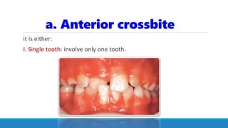 Transverse malocclusion (crossbite) | PPTX