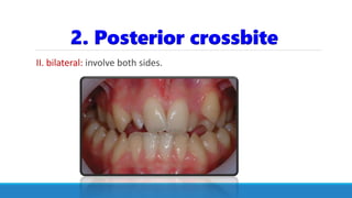 Transverse malocclusion (crossbite) | PPTX
