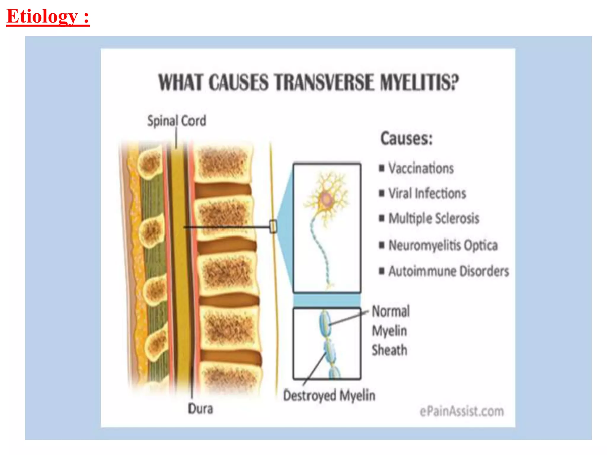 Transverse myelitis | PPTX