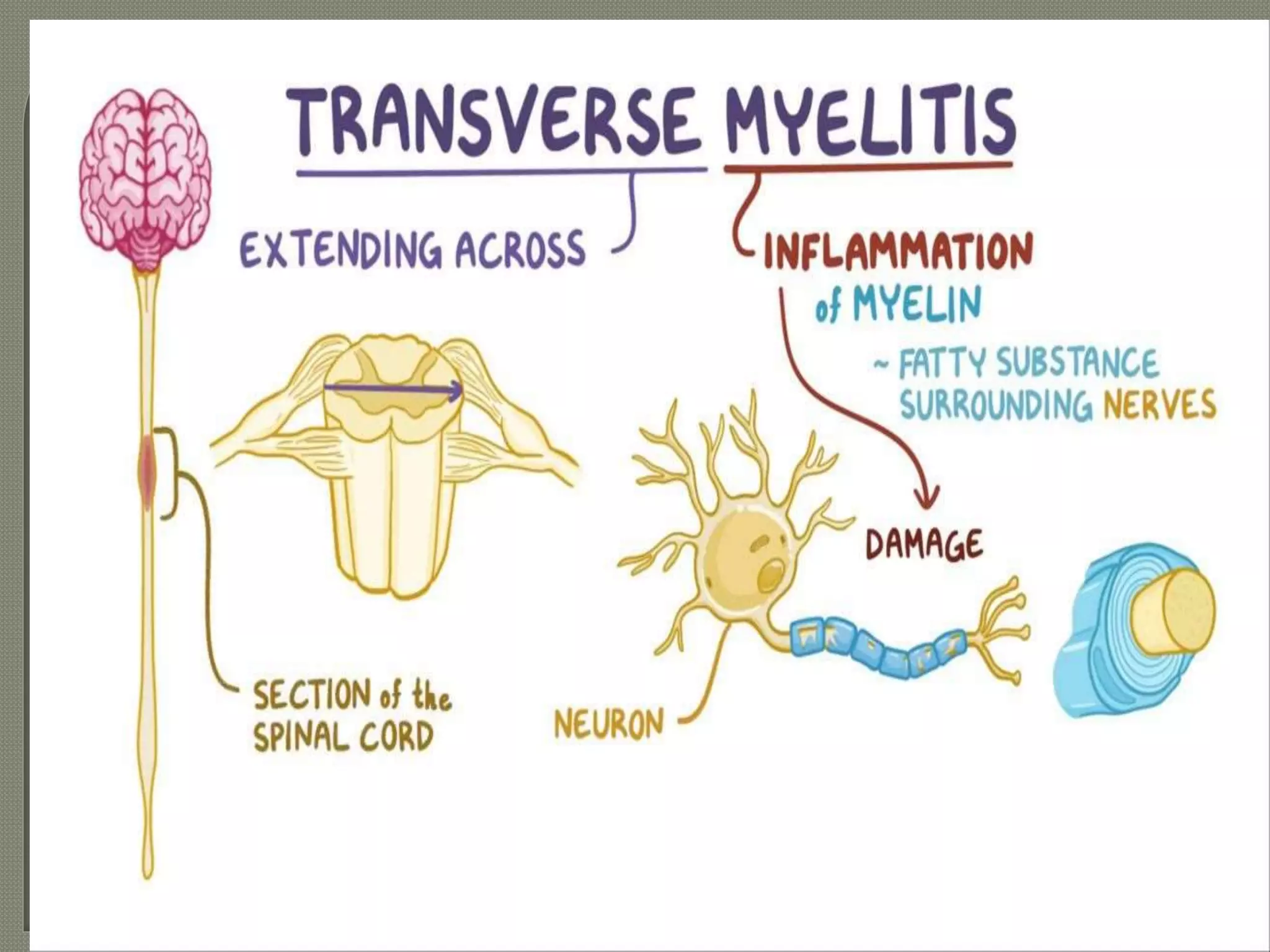 Transverse myelitis | PPTX