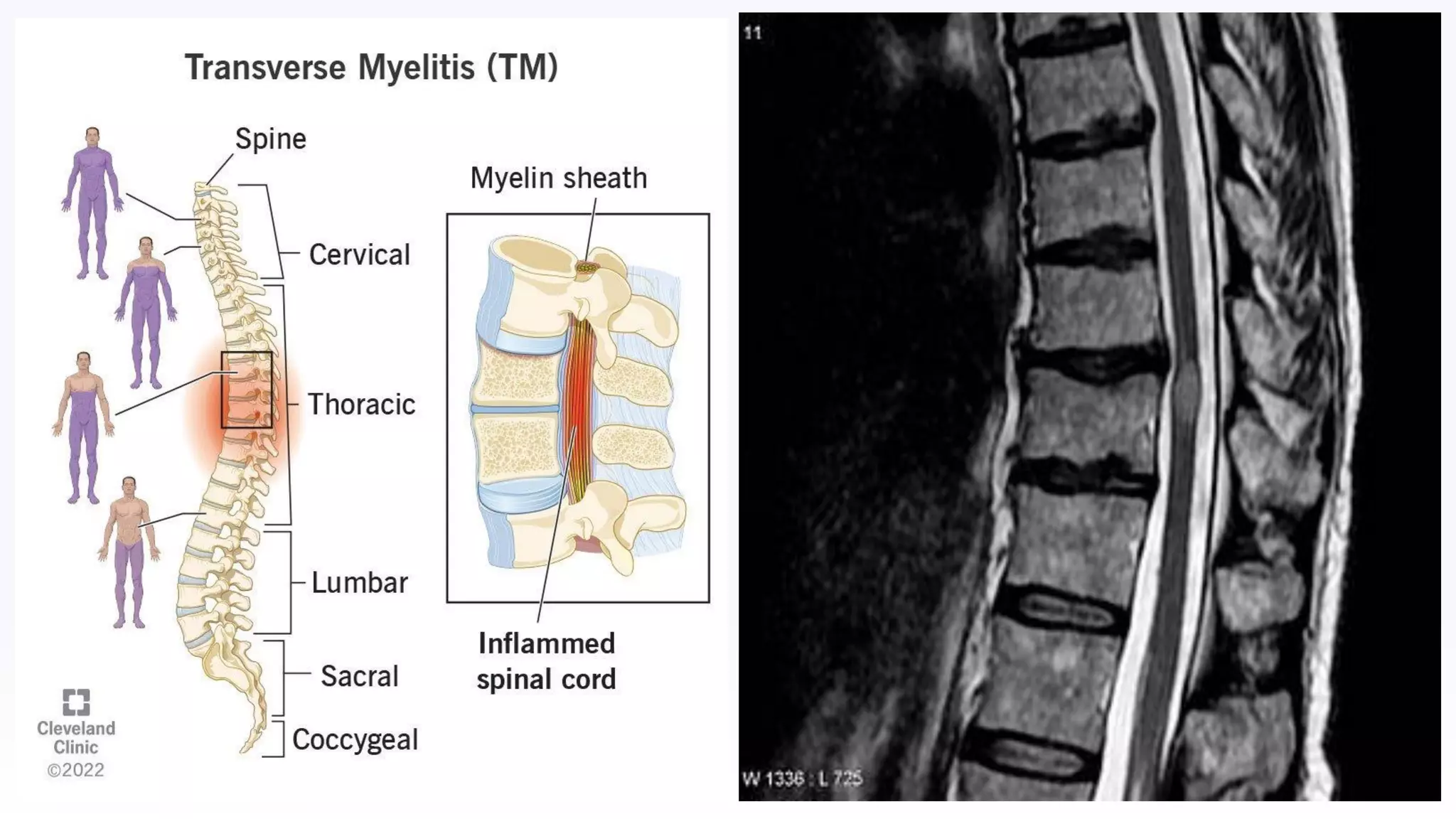 Transverse myelitis | PDF