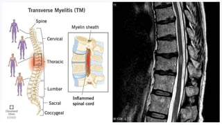 Transverse myelitis | PDF