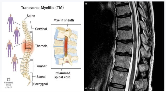 Transverse myelitis | PDF | Physical Therapy | Wellness