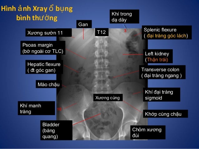 Những dấu hiệu cơ bản trên Xquang bụng by TranTrongTai