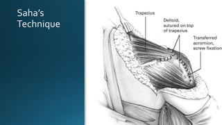 Trapezius to deltoid transfer.pptx | Free Download
