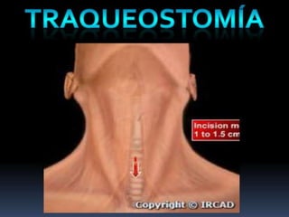 traquea.pptx