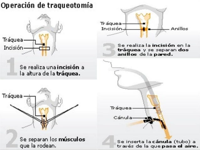 Traqueostomía