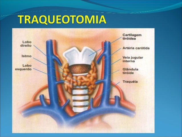 Traqueostomia