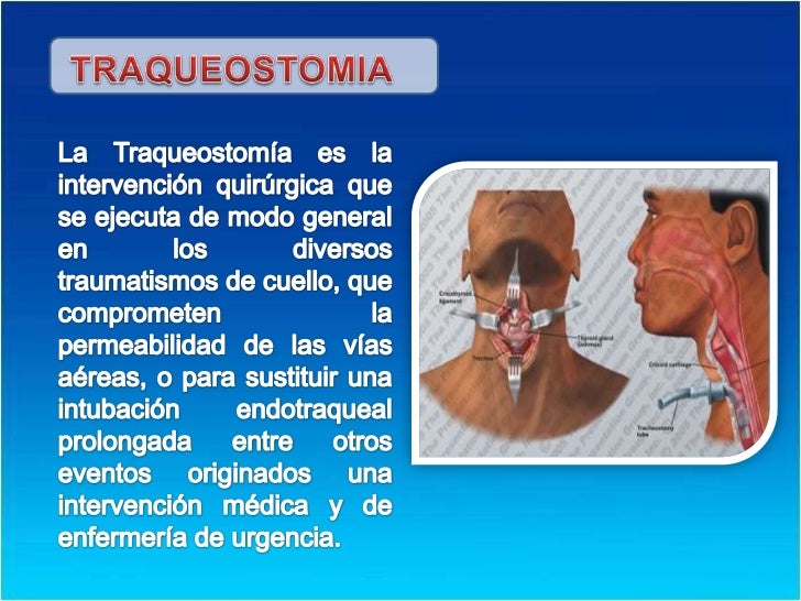 Traqueostomía