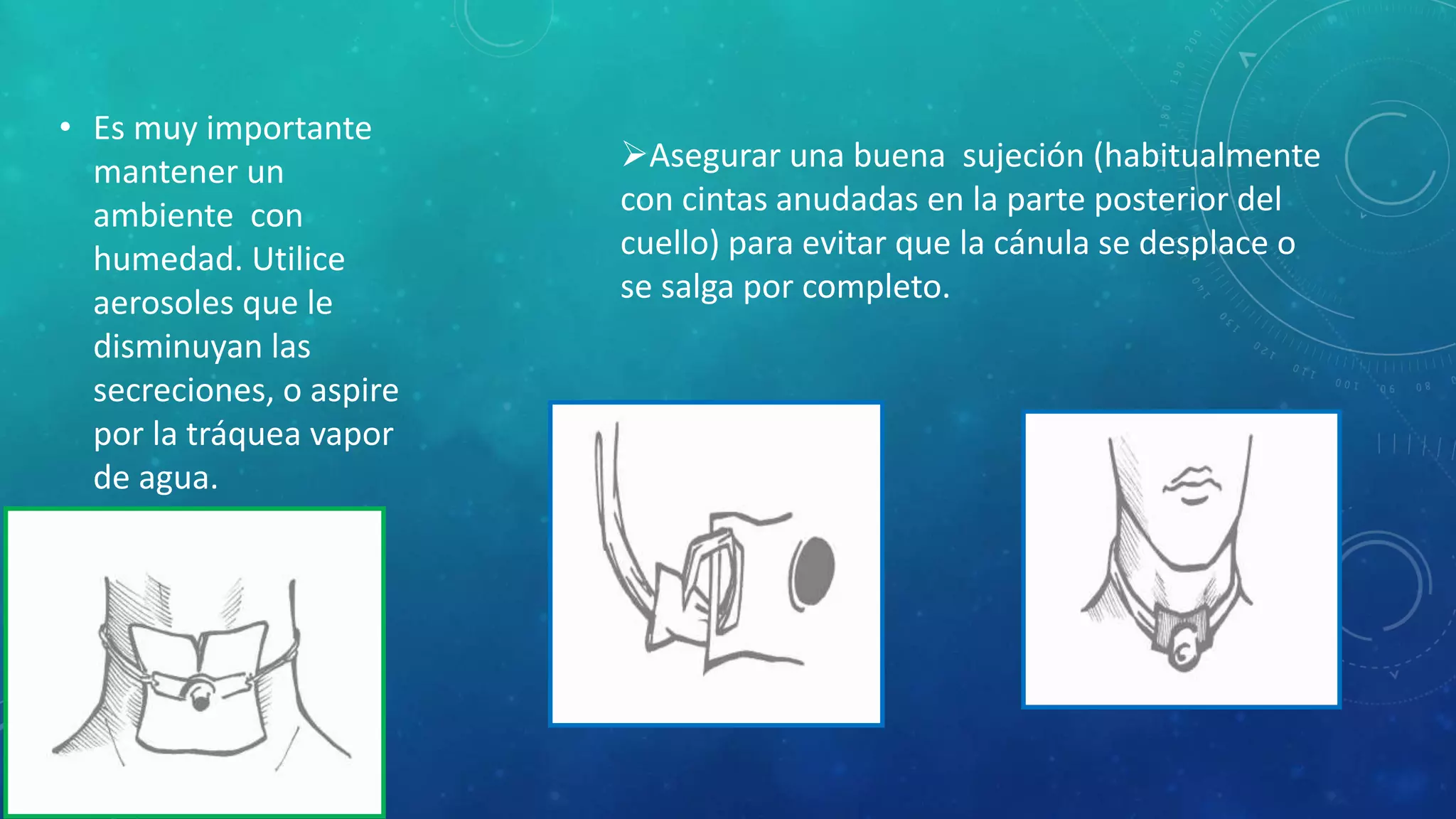 Traqueostomia y tecnica quirurgica | PPTX