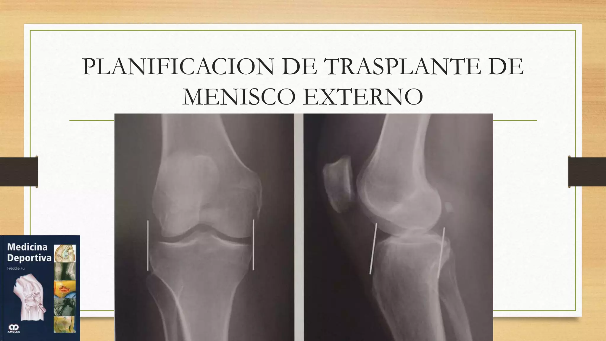 Trasplante de meniscos | PPT